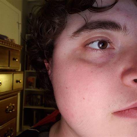 I Believe I May Have Temporalis Hypertrophy None Of My Doctors Know