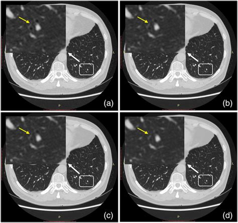 A 66‐year‐old Male A Axial Ct Image Reconstructed With Adaptive Download Scientific Diagram