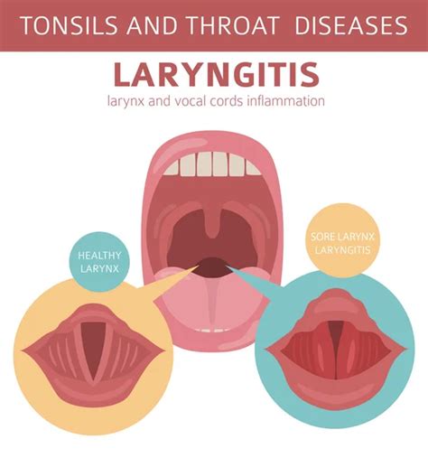 Tonsils Throat Diseases Pharyngitis Symptoms Treatment Icon Set Medical