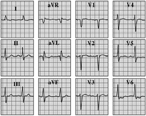 Intraventricular Conduction Delay