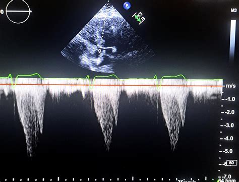 When Waves Collide A Guide To Sorting Out Doppler Drama