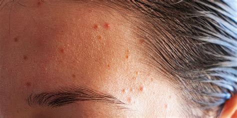 Pimple Like Bumps On Face