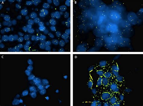 Alk Fish Analysis Of Cytological Samples Examples Of The Major