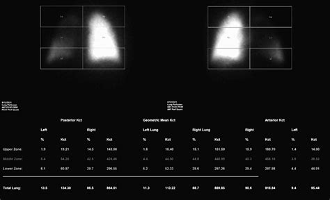 Perfusion Scan Demonstrating Significant Hypoperfusion Of The Left Lung