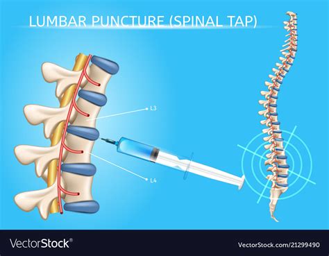 Lumbar Puncture Realistic Medical Scheme Vector Image