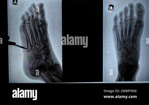 5th Metatarsal Fracture Stock Videos And Footage Hd And 4k Video Clips