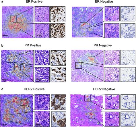saliency analysis for patch level biomarker status prediction examples