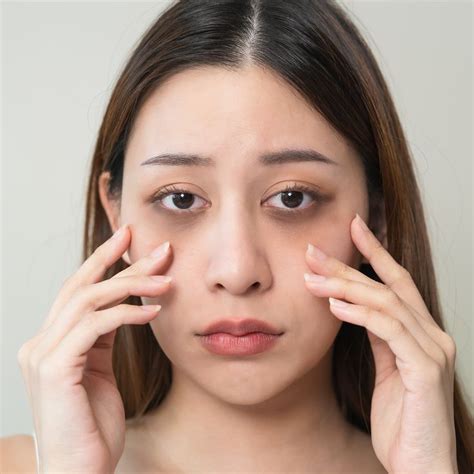 5 Cara Ampuh Hilangin Racoon Eyes Secara Alami No 2 Cuma Butuh 5 Menit Bacaankita