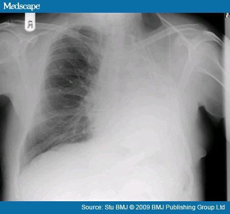 All About White Lung Disease Chronic Obstructive Pulmonary Disease