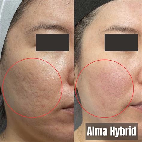 Affordable Acne Scar Repair Package Brisbane Cutis Dermatology
