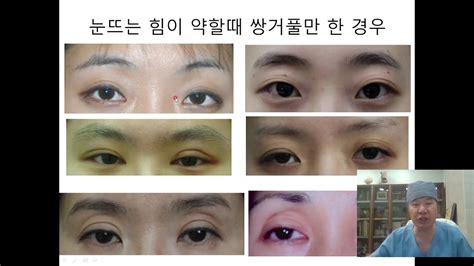 쌍거풀수술과 눈매교정술의 차이 Youtube