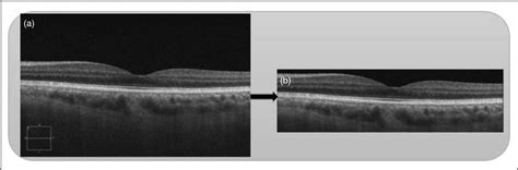 Figure 1 From Artificial Intelligence Based Detection Of Age Related Macular Degeneration Using