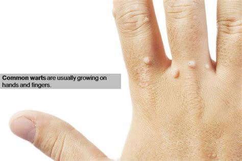 How To Recognize A Wart