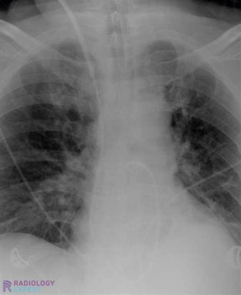 Chest X Ray Icu