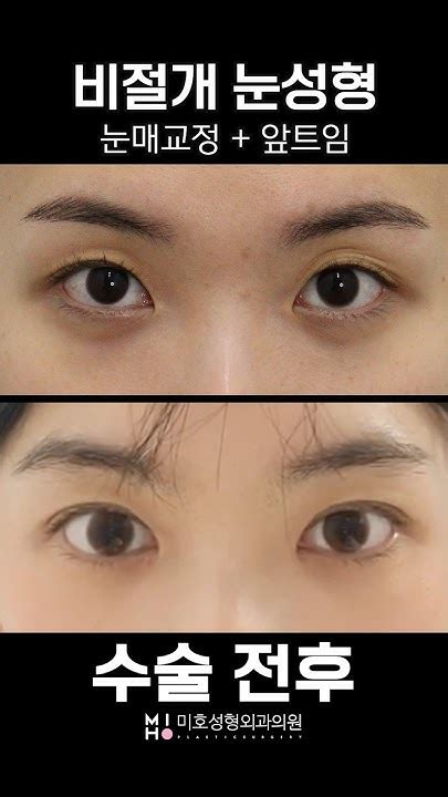 비절개 쌍수 후기👀 비절개쌍꺼풀눈매교정앞트임 Shorts Youtube