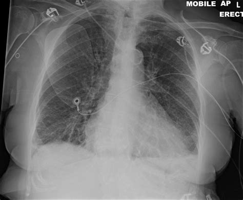 Kerley B Lines On Chest X Ray Article Lung Ultrasound Routine