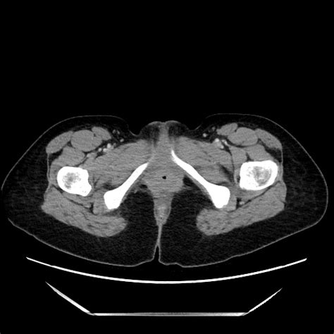 File Crohns Disease Terminal Ileitis Fistulizing Radiopaedia 98245 118784 Axial 176 Jpeg