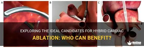 Exploring The Ideal Candidates For Hybrid Cardiac Ablation Who Can