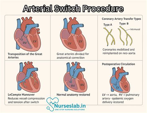 Arterial Switch Procedure Nurseslab
