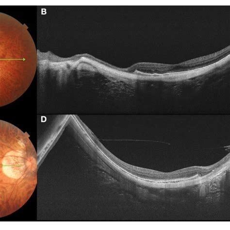 Pdf Morphologic Features Of Myopic Choroidal Neovascularization In Pathologic Myopia On Swept