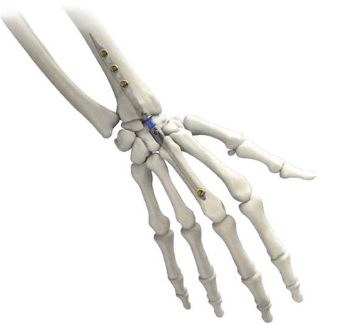 Wrist Intramedullary Nail Implate ® Skeletal Dynamics