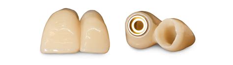 Monolithic Multilayer Zirconia Crowns In The Esthetic Zone