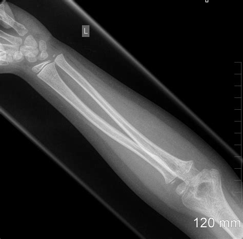 Radius And Ulna Elbow At Mikayla Whish Blog