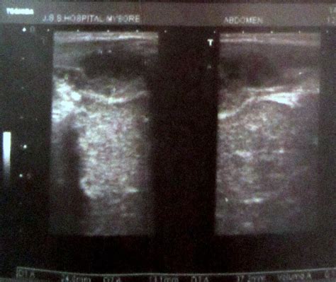 Abscess Measuring 3 42cm Noted With Few Hypoechoic Areas Just
