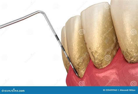 Gum Recession Process Medically Accurate Illustration Cartoondealer