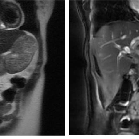 Magnetic Resonance Cholangiography Showing The Filling Defect In The Download Scientific