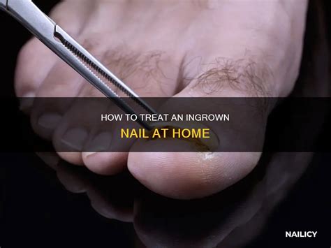 How To Treat An Ingrown Nail At Home Nailicy