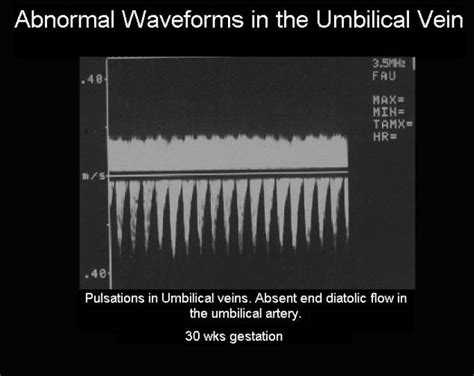 Abnormal Waveforms In The Umbilical Vein