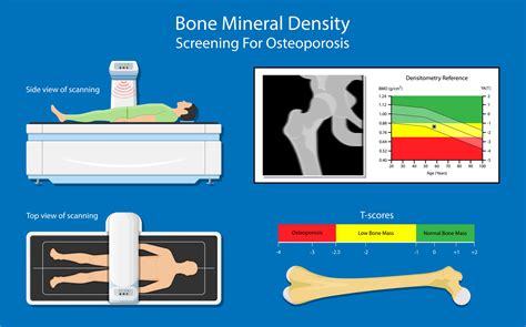 Dr Johnsons Tips For Improving Bone Density The Drug Free Way