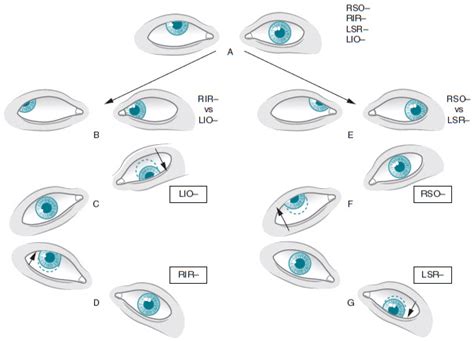 Sixth Nerve Palsy Ischemic Mononeuropathy Case File
