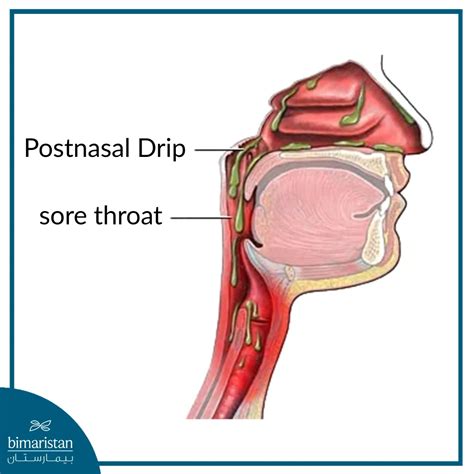Sinusitis Causes And Treatment In Turkey Bimaristan