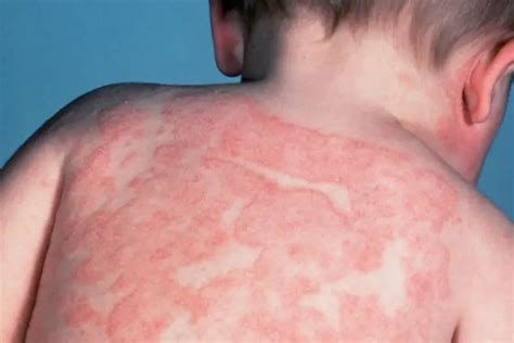 Atopic Dermatitis Eczema