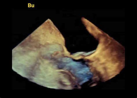 Mustafa Ahmed On Linkedin Pfo Closure For Stroke Prevention Is Like