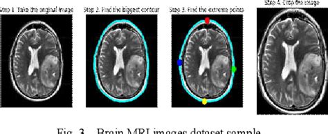 deep convolutional neural networks model based brain tumor detection in