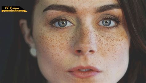 رفع و درمان کک و مک پوست صورت سیندرلا کالا