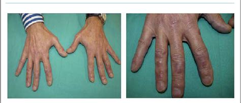 Figure 1 From A Rare Cutaneous Manifestation Of The Systemic
