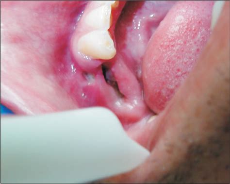 Dry Socket With Bone Graft Is That Even Possible 1311 Jackson Ave Dental Dentist In Long