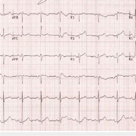 Ekg Indicating St Segment Elevation In Leads V1 V5 Download Scientific Diagram