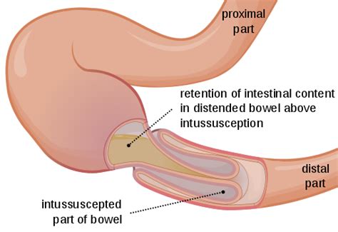 Intussusception Ultrasoundpaedia
