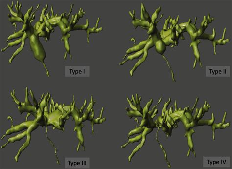 The Bismuth Classification For Biliary Strictures—3d Models Download The Bismuth Classification For Biliary Strictures—3d Models Download