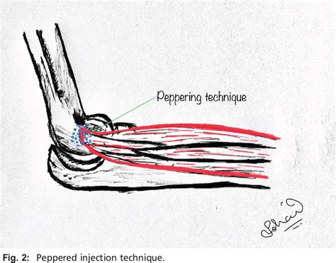 Pdf Peppering Versus Single Injection Technique In Tennis Elbow A Pdf Peppering Versus Single Injection Technique In Tennis Elbow A