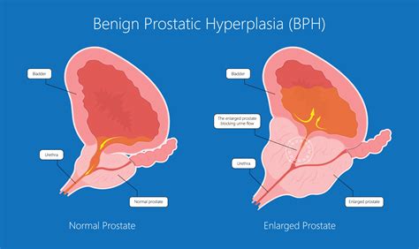Benign Prostatic Hyperplasia Its A Man Thing Aging Matters Magazine