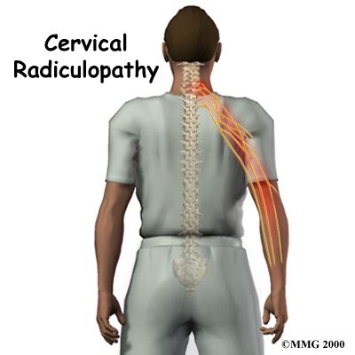 Cervical Radiculopathy Purposed Physical Therapy And Massage Greenville Sc