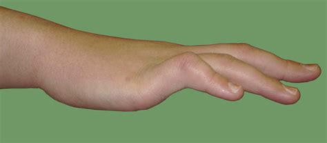 How Common Is Clinodactyly