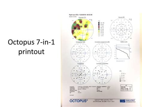 Interpretation Of Visual Fields With Special Reference To Octopus PDF