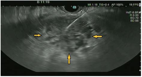 Case Of The Month May 2023 A 68 Year Old Man With Acute Cholangitis WFUMB